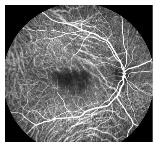 Qu'est ce qu'une angiographie rétinienne